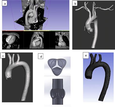 The Reconstructed Geometry Of Aorta A Segmentation From Ct Images In Download Scientific