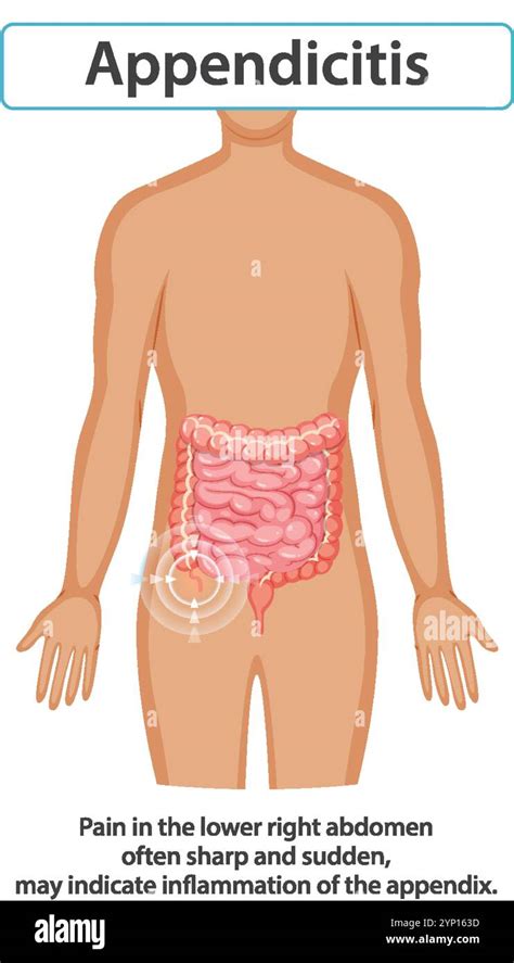 Diagram Showing Appendicitis Location And Symptoms Stock Vector Image