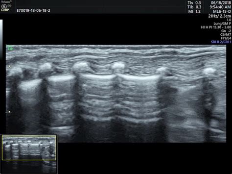 Protocol And Guidelines For Point Of Care Lung Ultrasound In Diagnosing