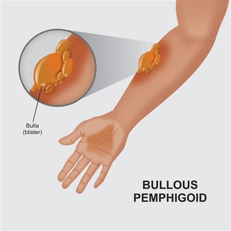 Bullous Pemphigoid Over 4 Royalty Free Licensable Stock Illustrations