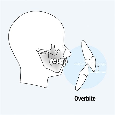 Premium Vector Tooth Problem Side View Man With Misaligned Teeth
