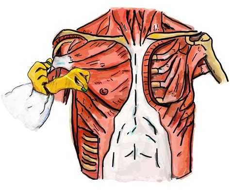 ห้องฉุกเฉินต้องรู้ 📌 คำถาม ทำไมต้องย้ายตำแหน่งเจาะปอดในtension Pneumothorax เทนชั่น นิวโมทอ