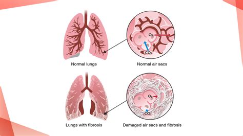 Understanding PF PulmonaryFibrosis360