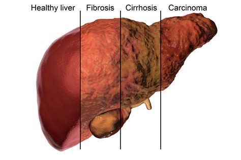 Stages Of Liver Disease 2 Photograph By Kateryna Konscience Photo Library Pixels