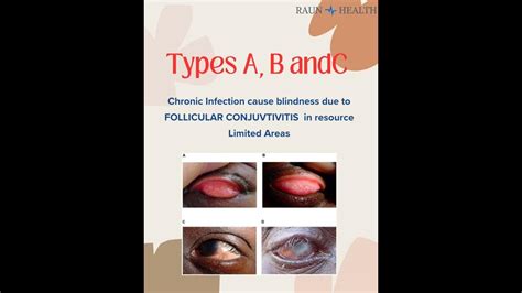 Chlamydia Trachomatis Serotypes Youtube