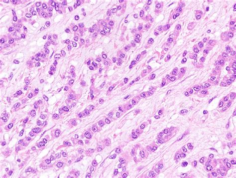 C Nfatc2 Rearramged Sarcoma Striking Epithelioid Morphology