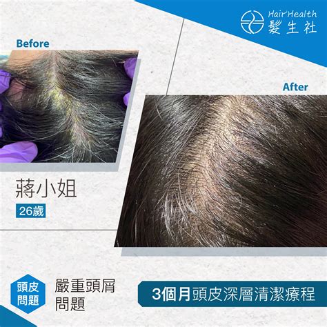【個案分享 26歲蔣小姐】 Hairhealth 髮生社 專業中醫團隊．專治脫髮、頭皮問題