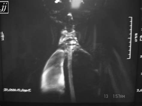 Brain Tonsillar Herniation And Spinal Antelisthesis And Right Plural