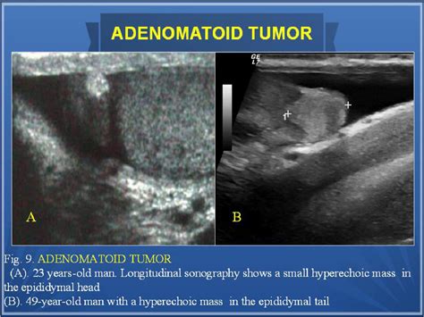 Figure 6 From Sonographic Findings Of Epididymal Masses Semantic Scholar
