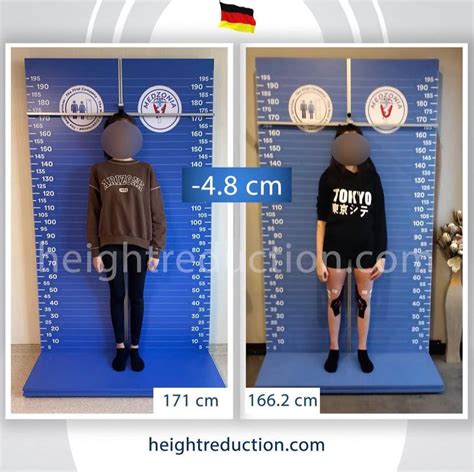 What Is Height Reduction Surgery