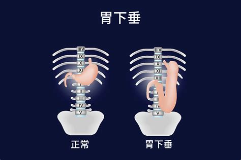 胃下垂腹部真人图片