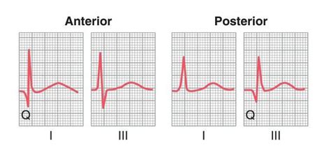 Anterior And Posterior Wall Infarction Medizzy