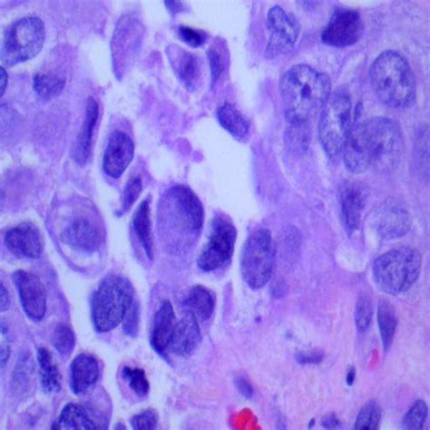 Github Creative Mudassirlung Cancer Detection