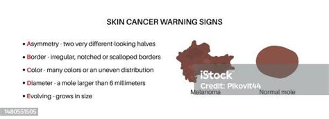 Melanoma Warning Signs Stok Vektör Sanatı And Asimetrisi‘nin Daha Fazla