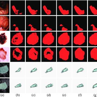 Qualitative Examples Of Polyp Segmentation Skin Lesion Segmentation Download Scientific