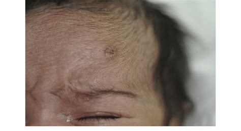 Single Nodule On The Left Side Of The Forehead Download Scientific