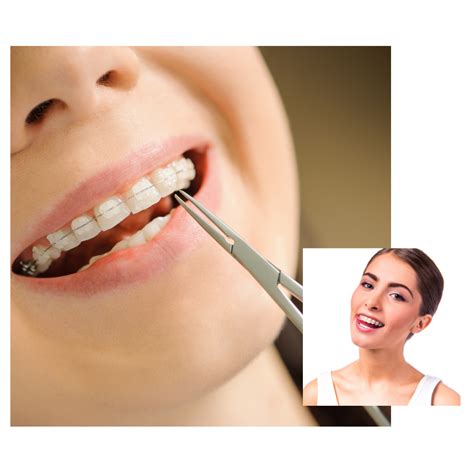 Ceramic Braces Smileville Orthodontics
