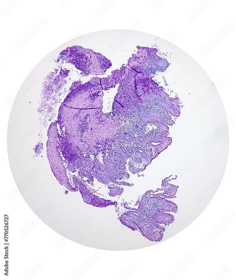 Sigmoid Colon Colonoscopic Biopsy Chronic Nonspecific Colitis Show