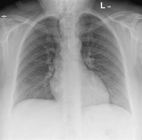 Can Pneumonia Cause Tracheal Deviation At Keith Maxey Blog