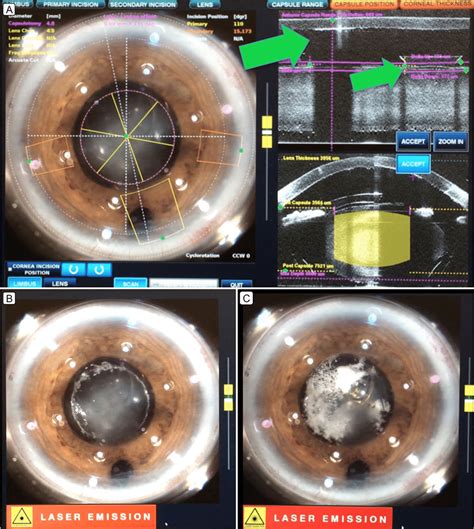 Lensar Femtosecond Laser