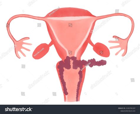 Illustration Stage Cervical Cancer Stock Illustration 2145791337