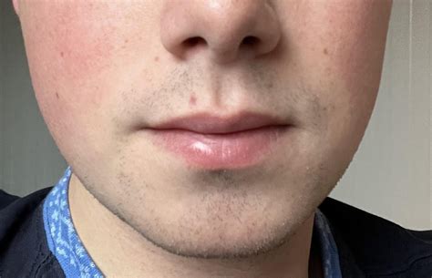 Hyperpigmentationscar Question Rdermatologyquestions