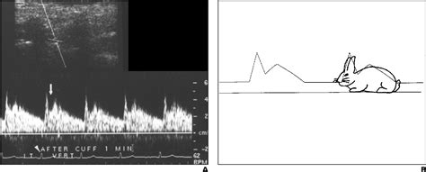 Pdf A Spectrum Of Doppler Waveforms In The Carotid And Vertebral Arteries Semantic Scholar