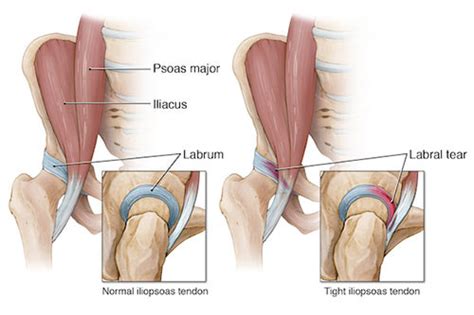 Hip Tendonitis Treatment Nyc Hip Tendon Specialist In Midtown Manhattan
