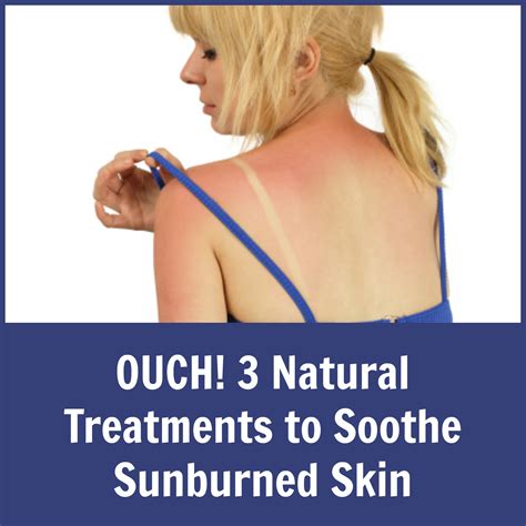 Ouch 3 Natural Treatments To Soothe Sunburned Skin Makes Scents