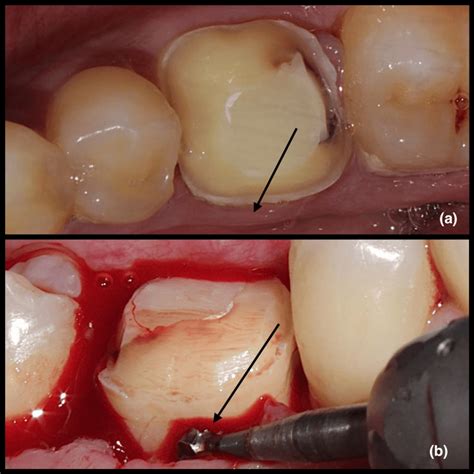 Biologic Width Following Different Crown Lengthening Procedures A Six