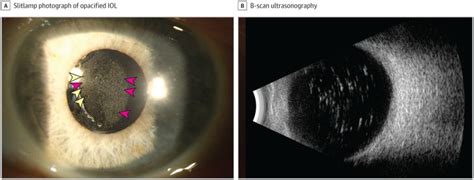 Dystrophic Calcification In Silicone Intraocular Lens Implant