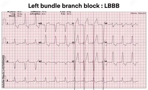 Electrocardiogram Show Left Bundle Branch Block LBBB Heart Beat CPR
