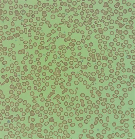 Les Elliptocytes Et Les Ovalocytes