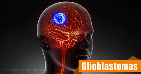 Glioblastoma Multiforme Astrocytoma Grade Types Causes Symptoms 103320