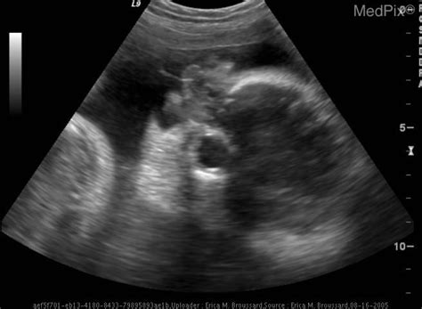 Encephalocele