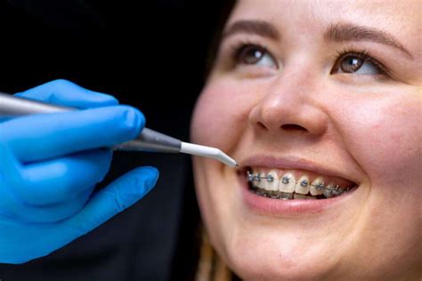 Qué Ocurre Si Se Sueltan Los Brackets Y Qué Hacer