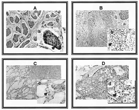 P53 Protein Expression In Human Breast Cancer Wild Type And Mutant P53