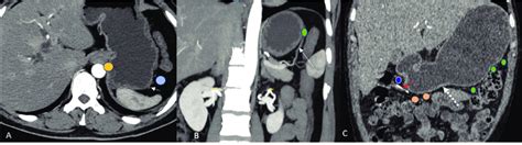 Perigastric Lymph Nodes Lns Along Greater Curvature Locations Of A