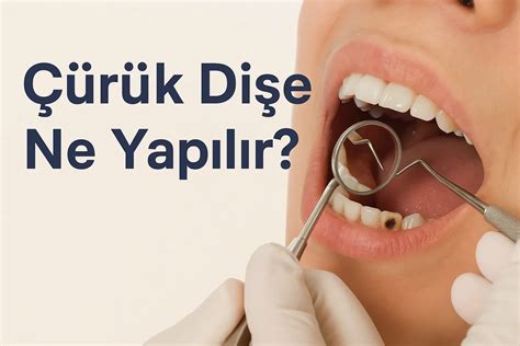 Çürük Dişe Ne Yapılır En Etkili Tedavi Yöntemleri