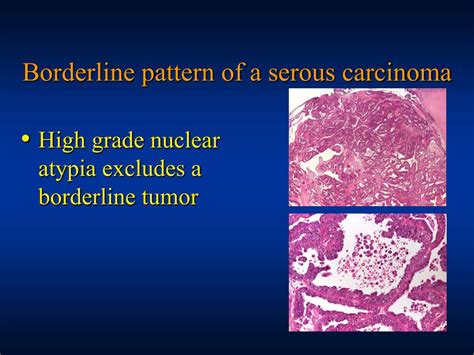 Ppt Ovarian Borderline Tumors Powerpoint Presentation Free Download