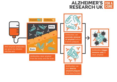 New Alzheimers Treatment Lecanemab Makes The Headlines Whats Next