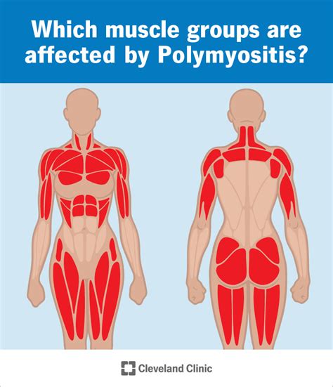 Polymyositis Cause