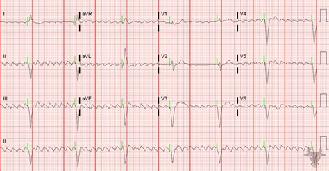 Atrial Flutter Ecg Stampede
