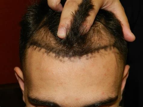 Mens Hair Loss Doctor Near Me Janell Moye
