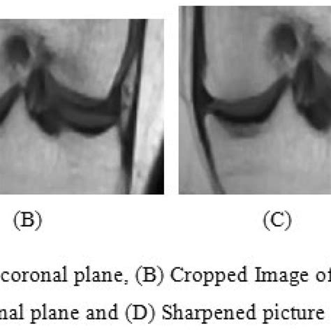 Watershed Algorithm And Adaptive Threshold Canny Edge Detection Based