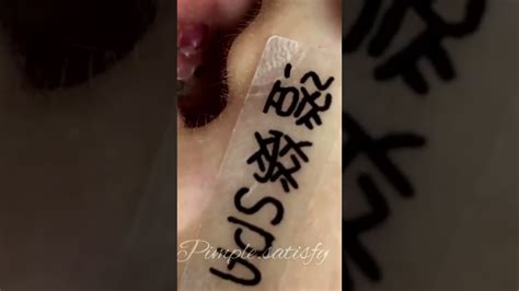 Pimples Removal Tiktok Compilation Extracting Blackheads And