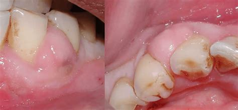 What Is The Difference Between Gum Abscess And Periodontal Abscess