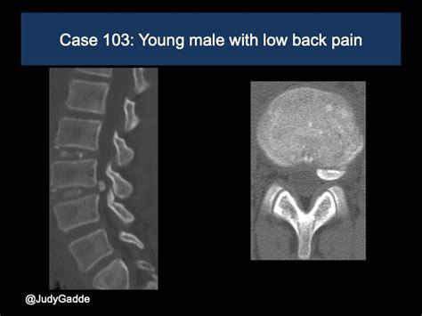Spine Cases — Neuroradiologyu