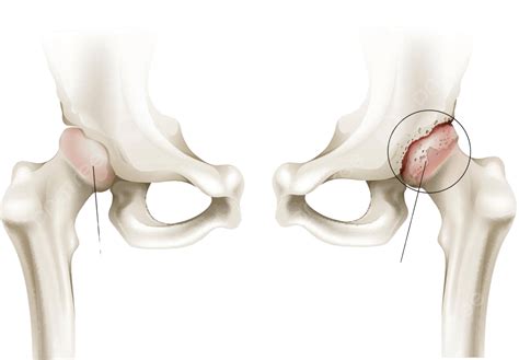 Arthritis Of The Hip Joint Graphic Hip Stiffness Synovial Capsule