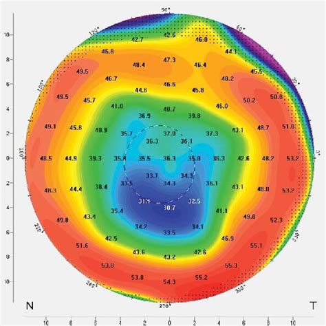 Corneal Topography Of Patient Ch Download Scientific Diagram